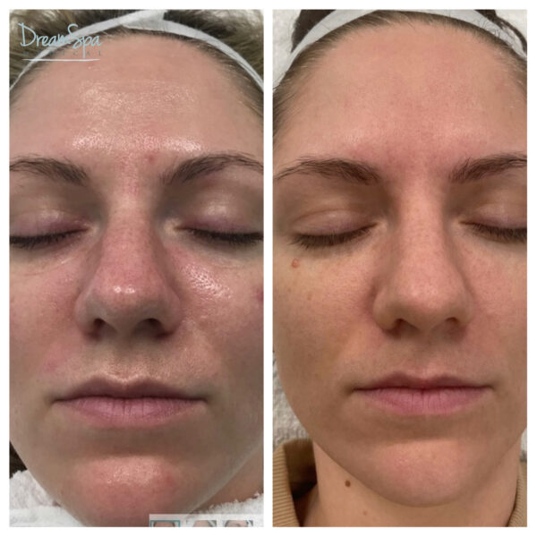 Acne Clinic 10 - Dream Spa Medical