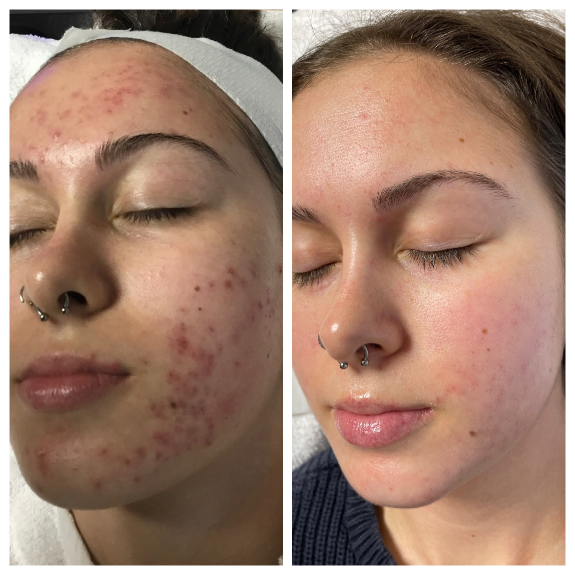 Hormonal Acne and How to Treat It with Medical Aesthetics - Dream Spa Medical - Blog