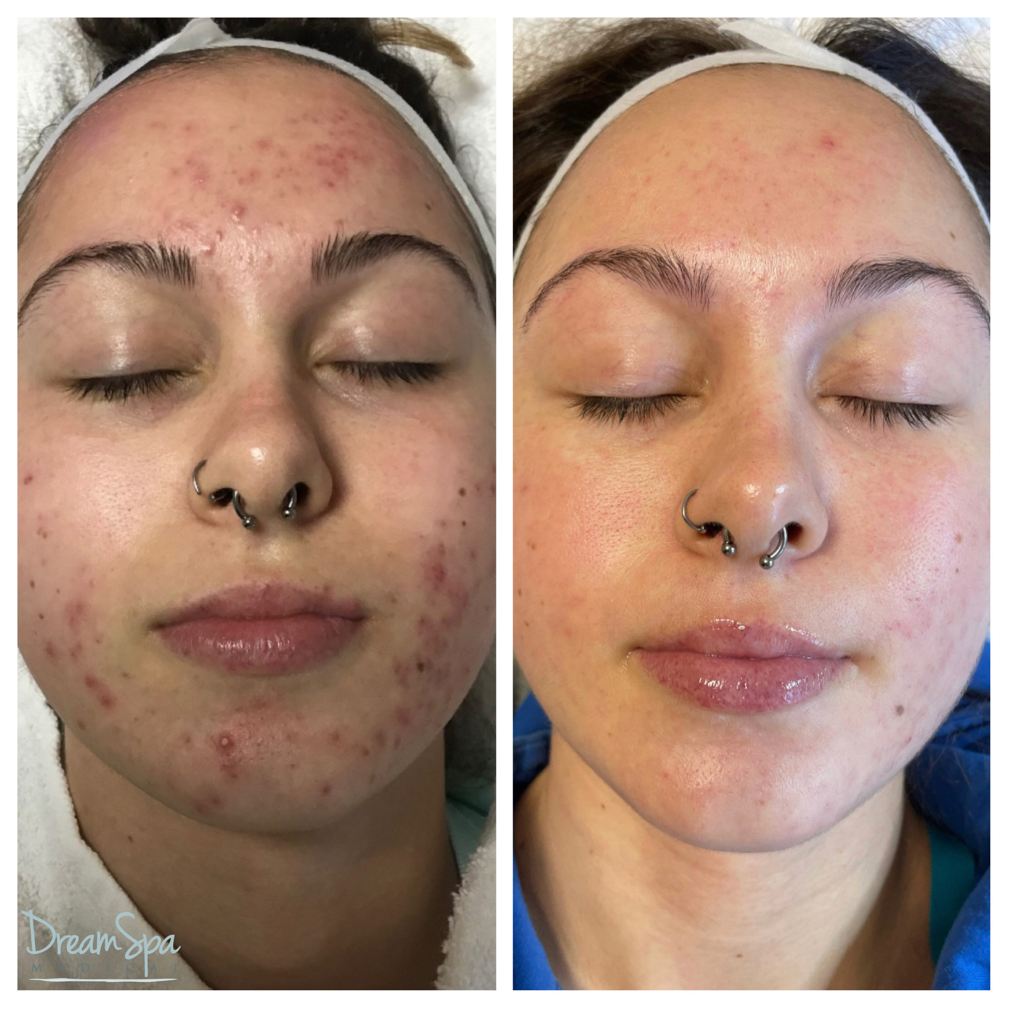 Acne Clinic 6 - Dream Spa Medical