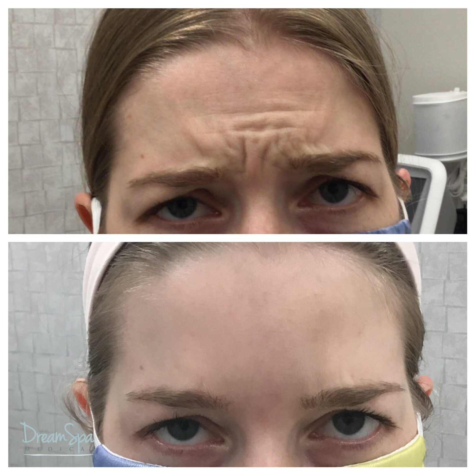 Botox 11 - Dream Spa Medical