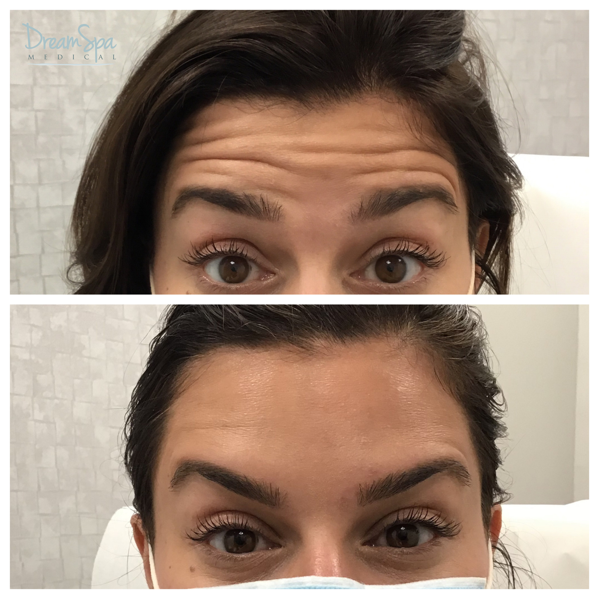 Botox 12 - Dream Spa Medical