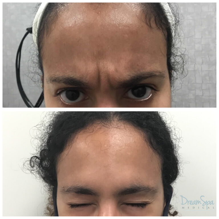 Botox 13 - Dream Spa Medical