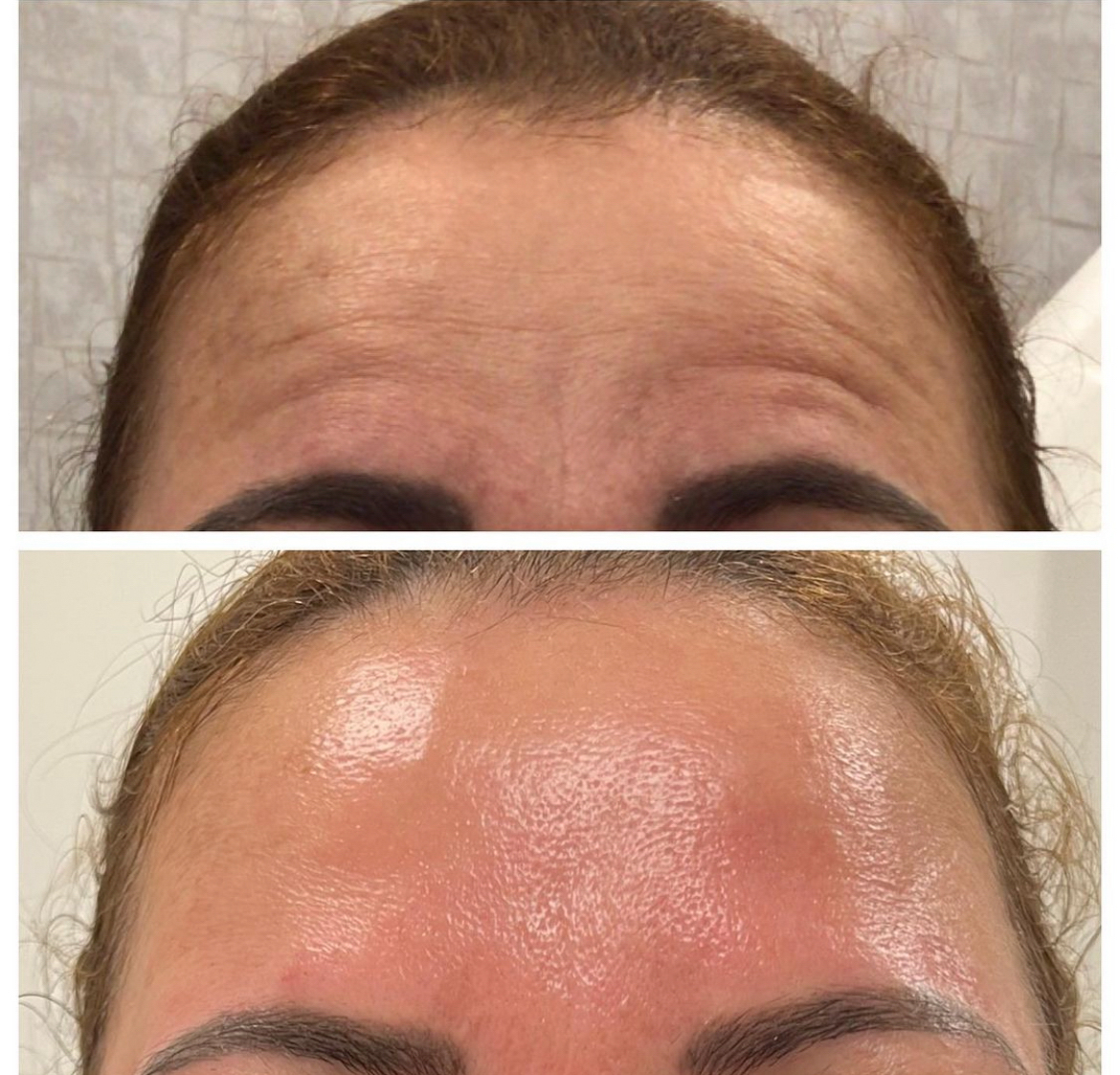 Botox 3 - Dream Spa Medical