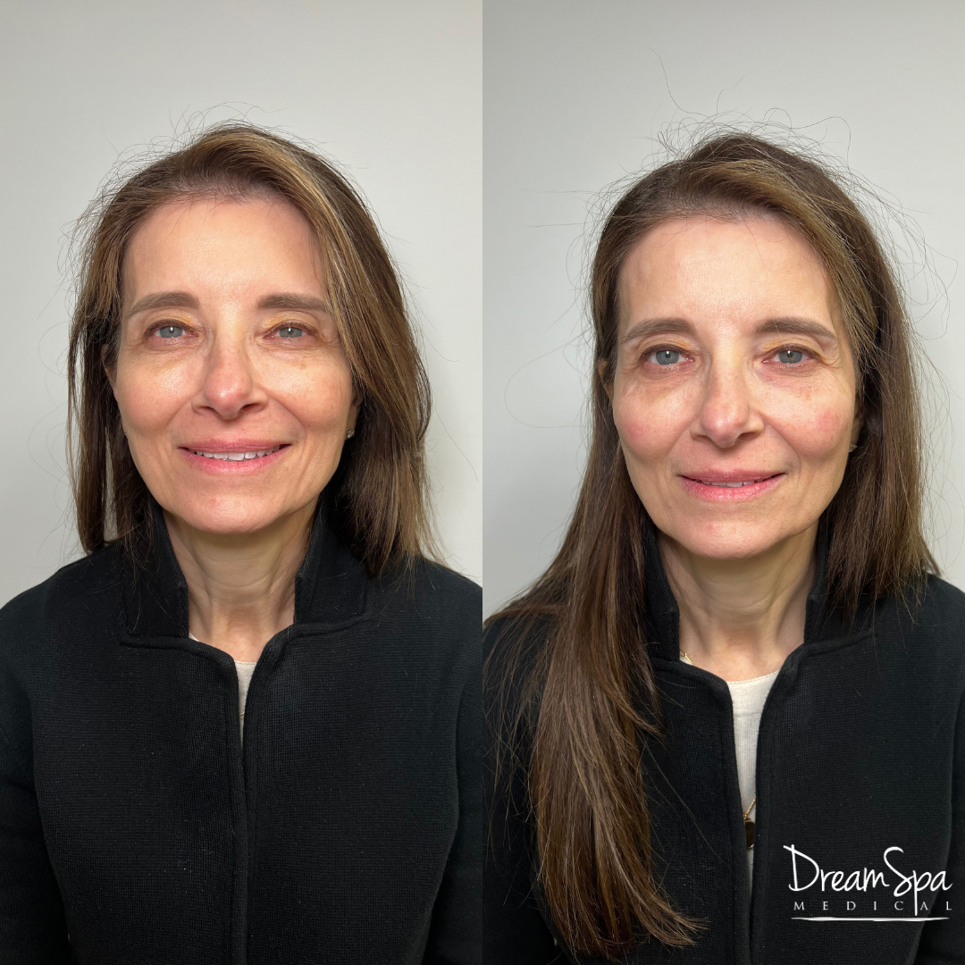 Filler (Cheeks + Chin) 2 - Dream Spa Medical