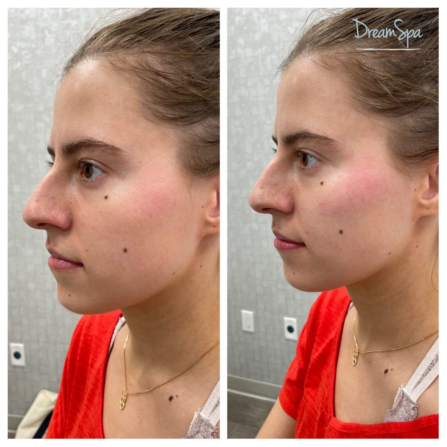 Filler (Cheeks + Chin) 4 - Dream Spa Medical