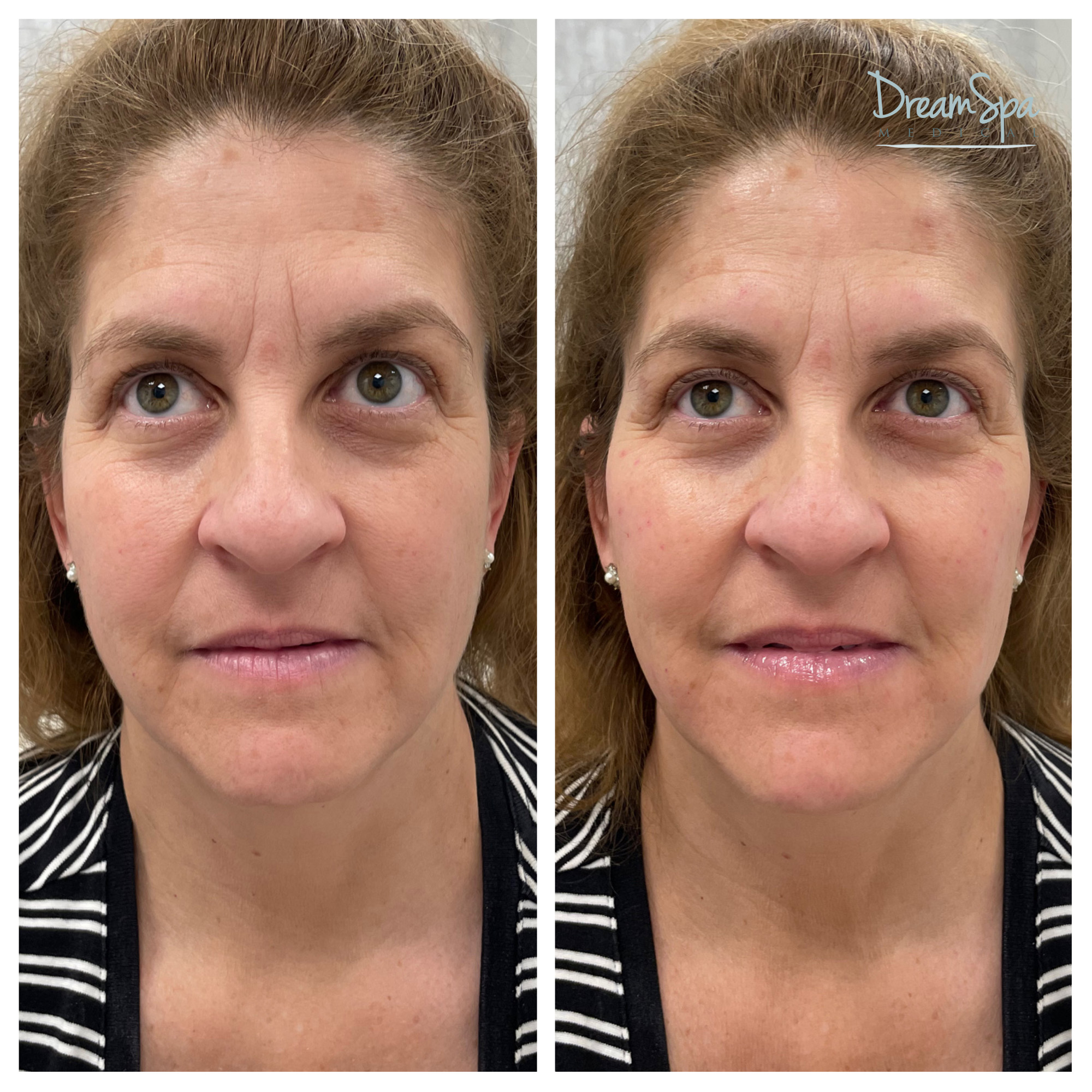 Filler (Cheeks + Chin) 6 - Dream Spa Medical