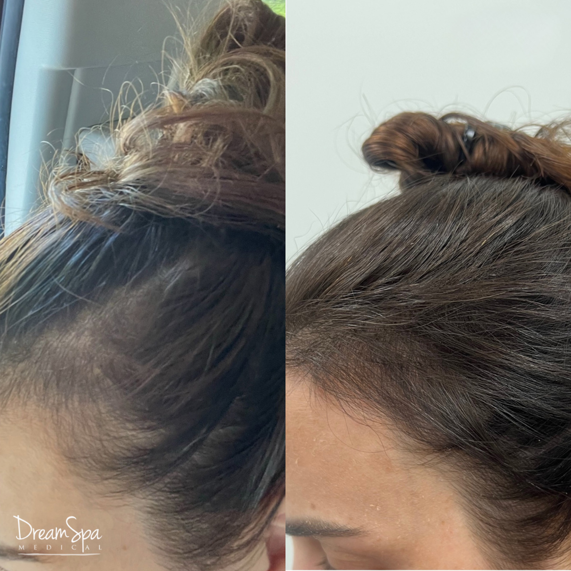 Non-Surgical Hair Restoration: PRP Hair Injections - Dream Spa Medical ...