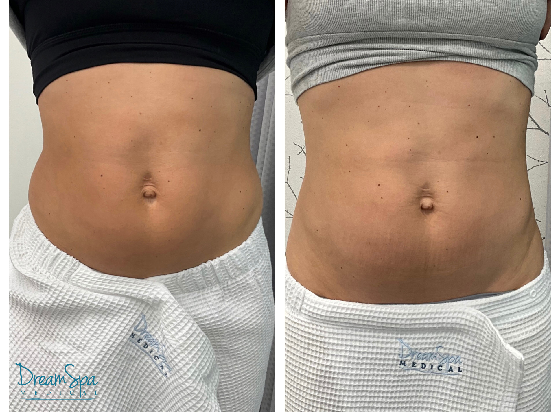 Emsculpt for Diastasis Recti - Dream Spa Medical - Blog
