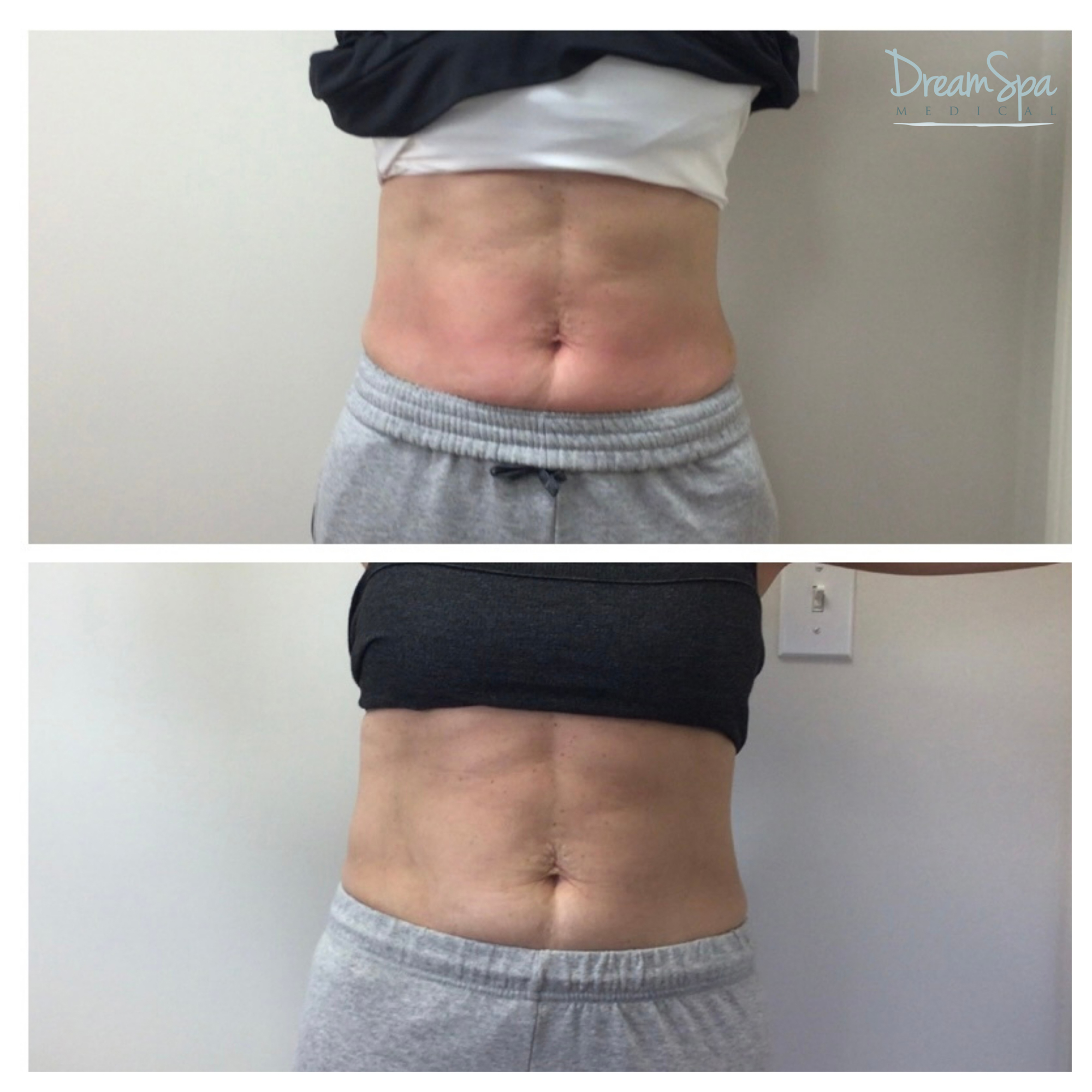 EON Luxe + VelaShape 1 - Dream Spa Medical