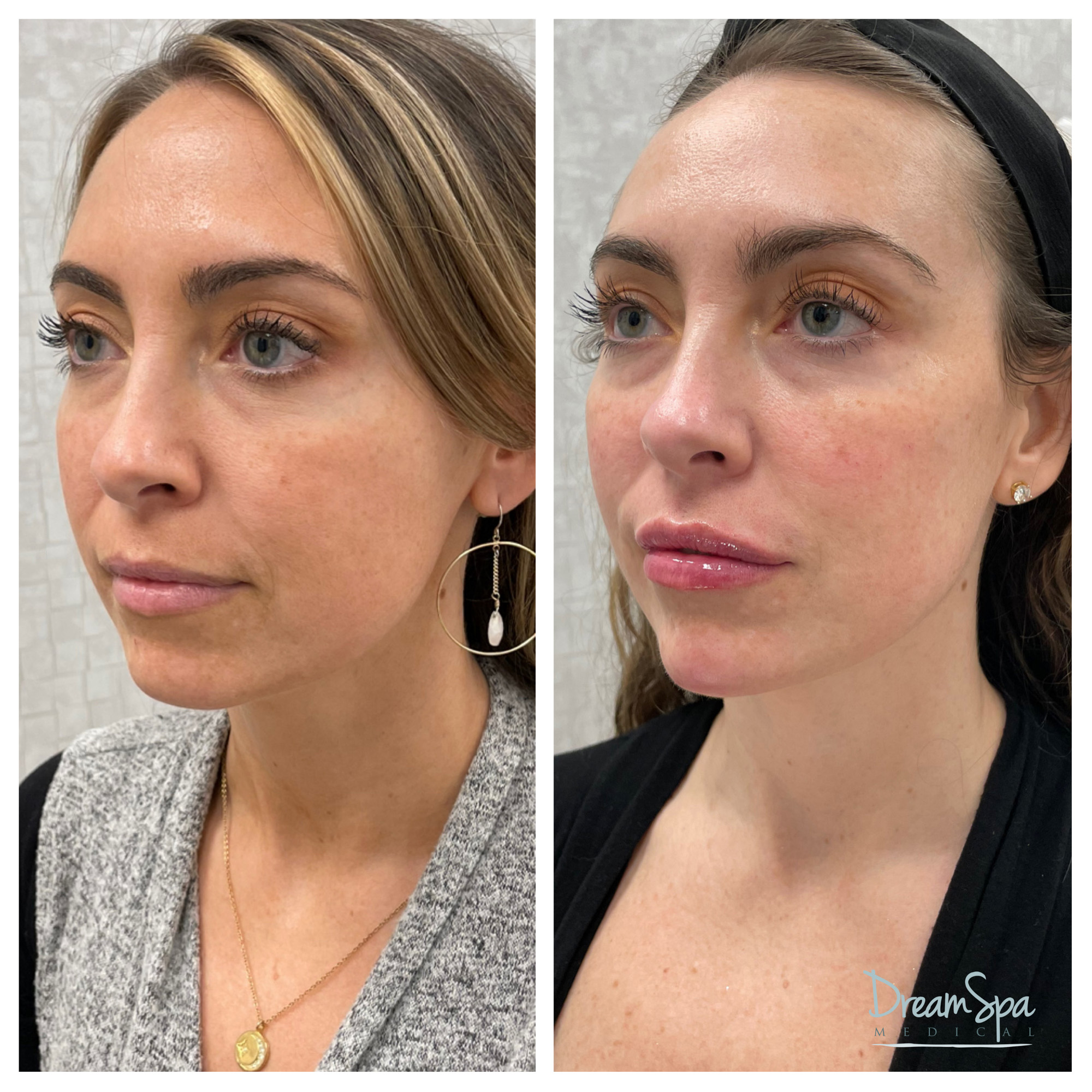 Filler (Full Face) 6 - Dream Spa Medical