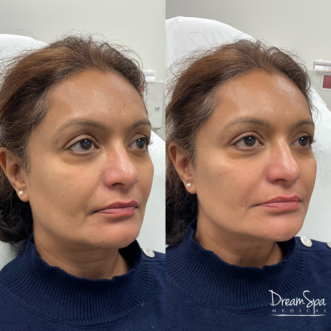 Filler (Full Face) 2 - Dream Spa Medical