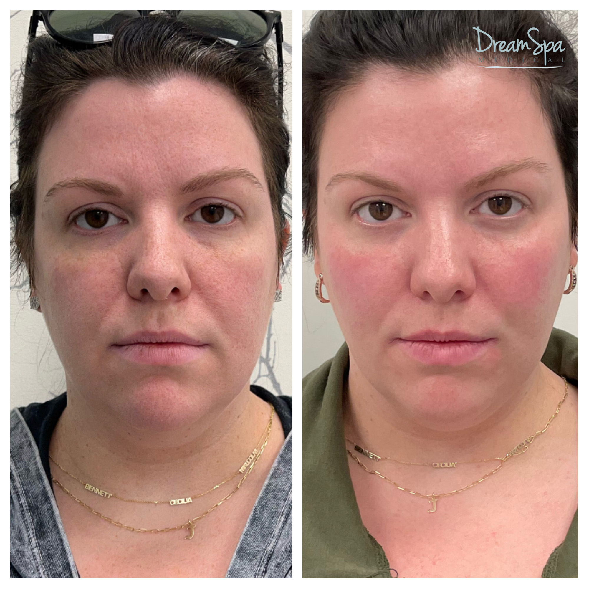 Do Fillers Make You Look Fake? - Dream Spa Medical - Blog