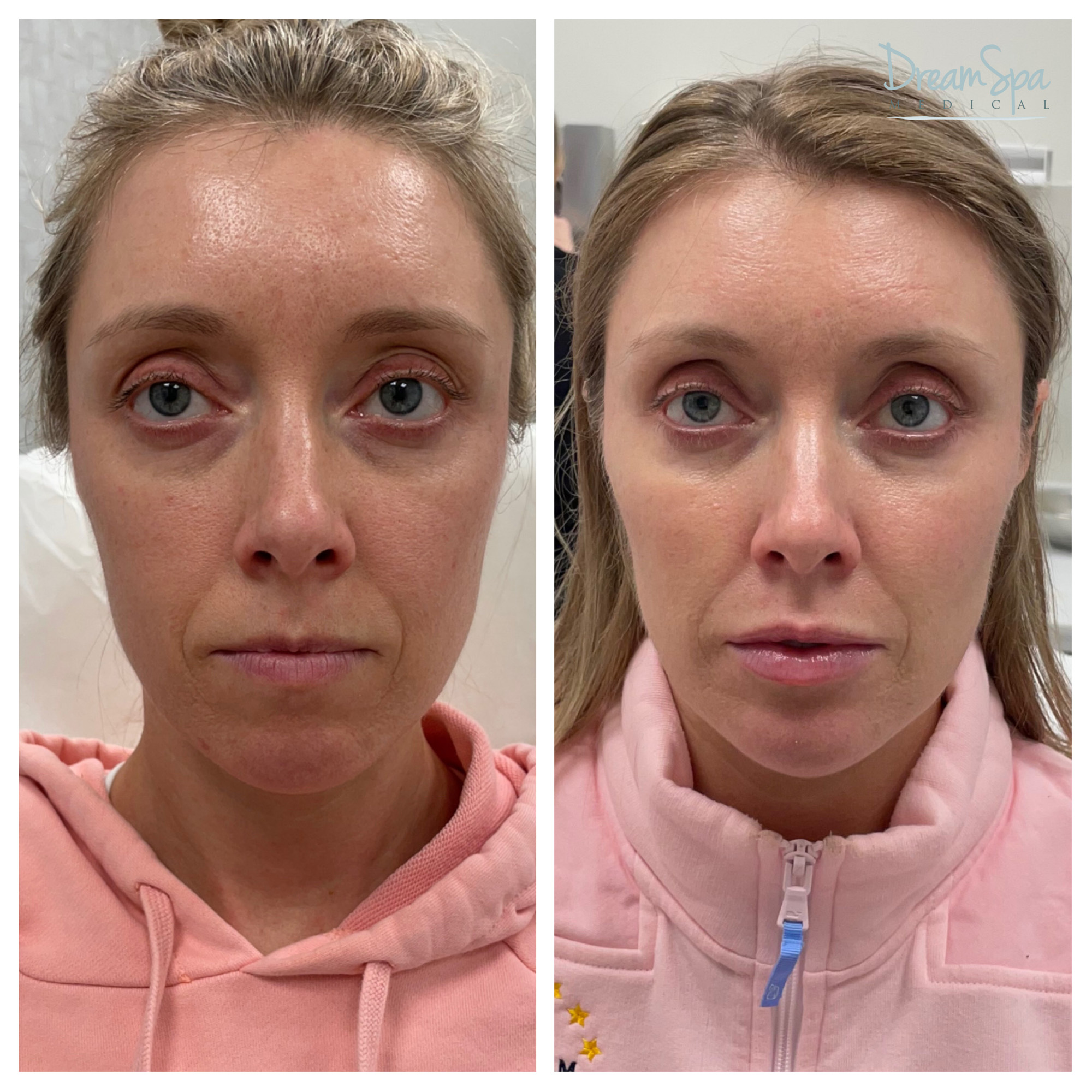 Filler (Full Face) 4 - Dream Spa Medical
