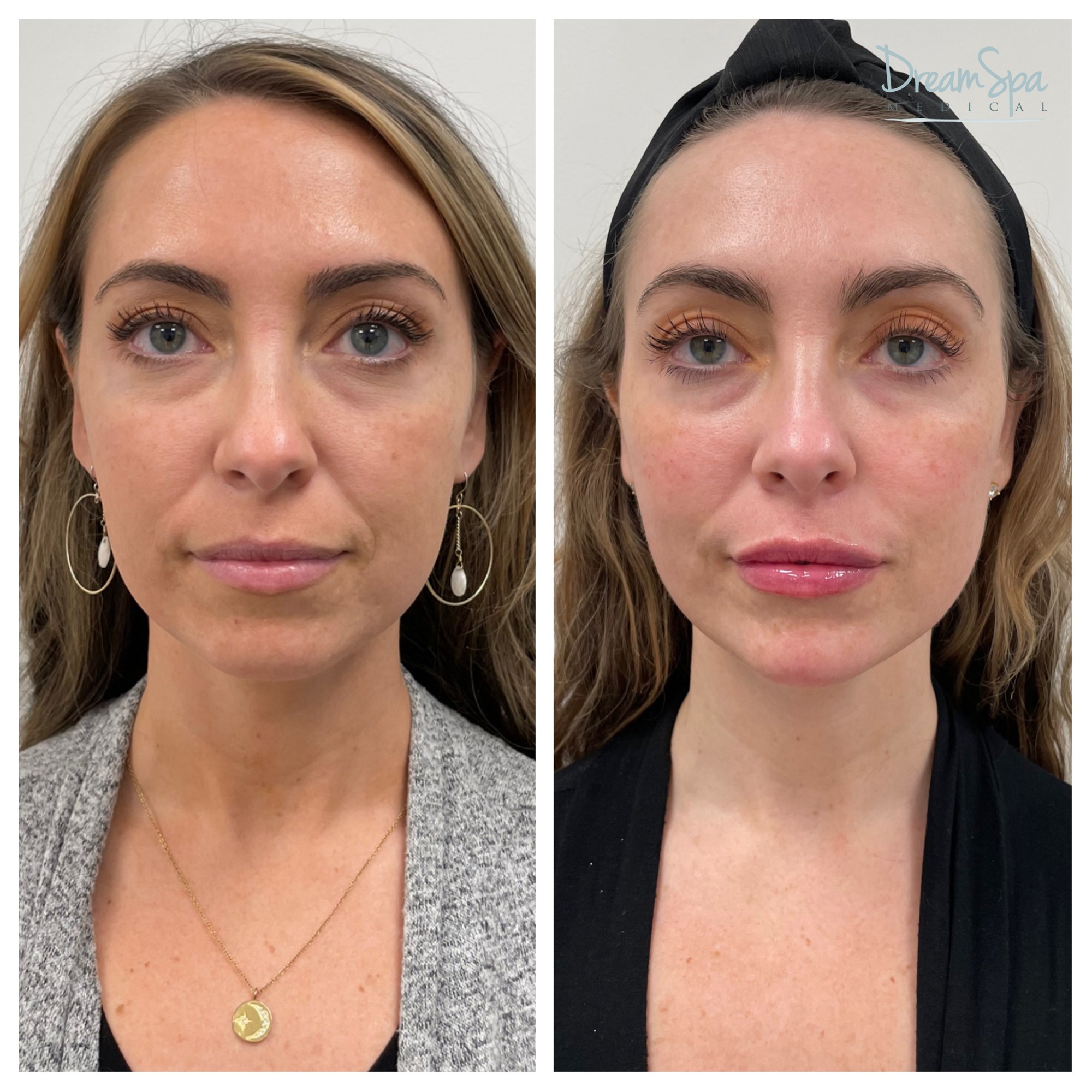 Filler (Full Face) 6 - Dream Spa Medical