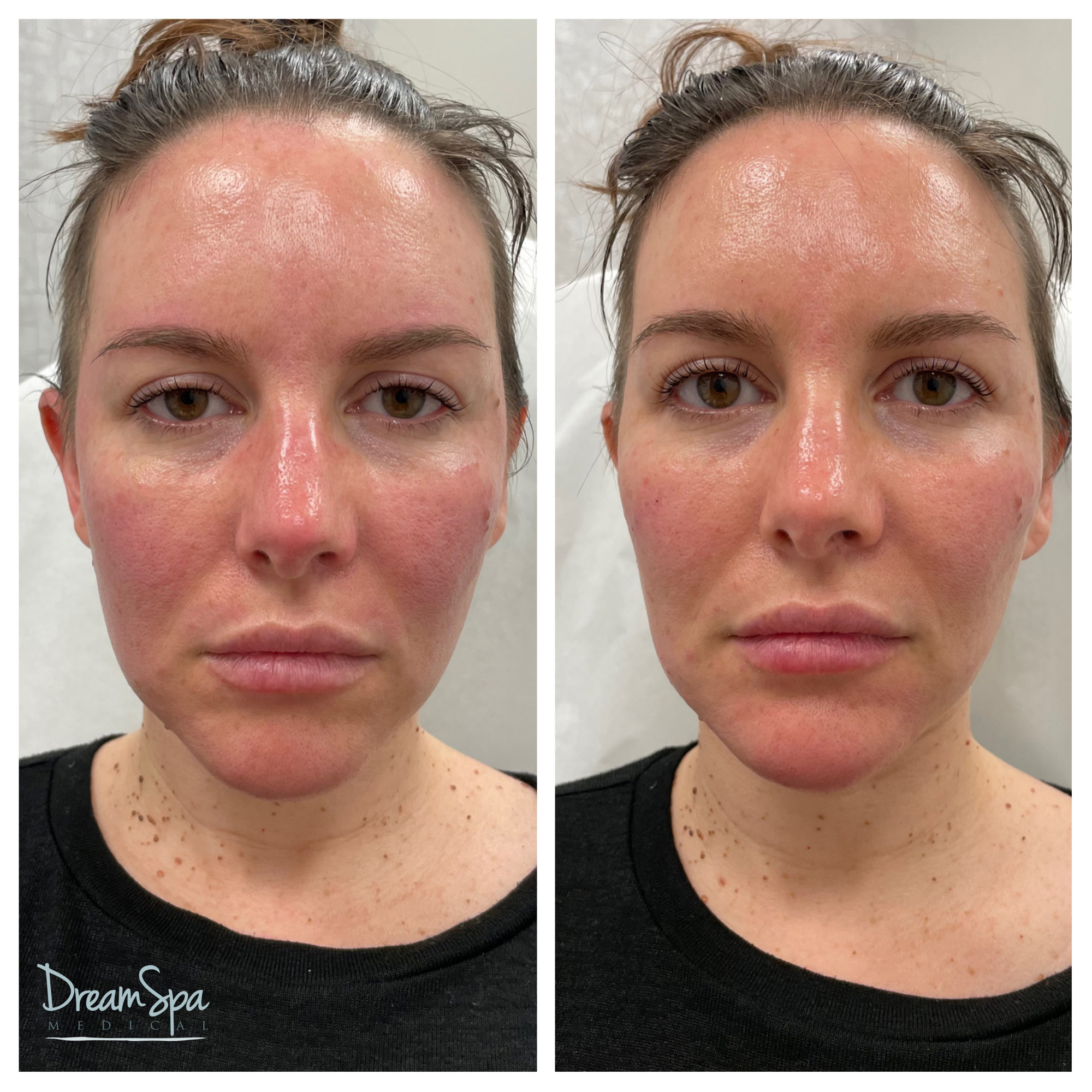 Filler (Full Face) 7 - Dream Spa Medical