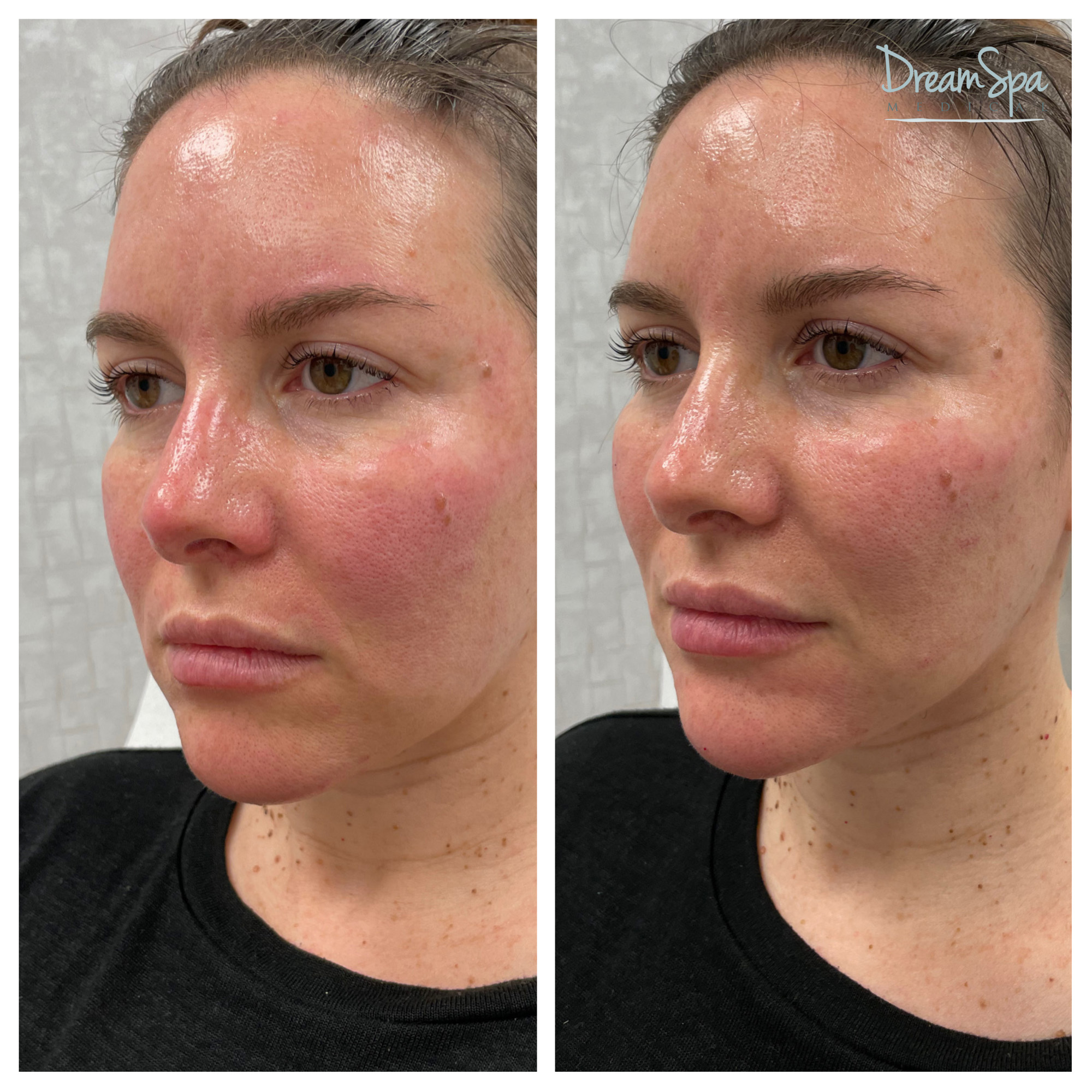 Filler (Full Face) 7 - Dream Spa Medical