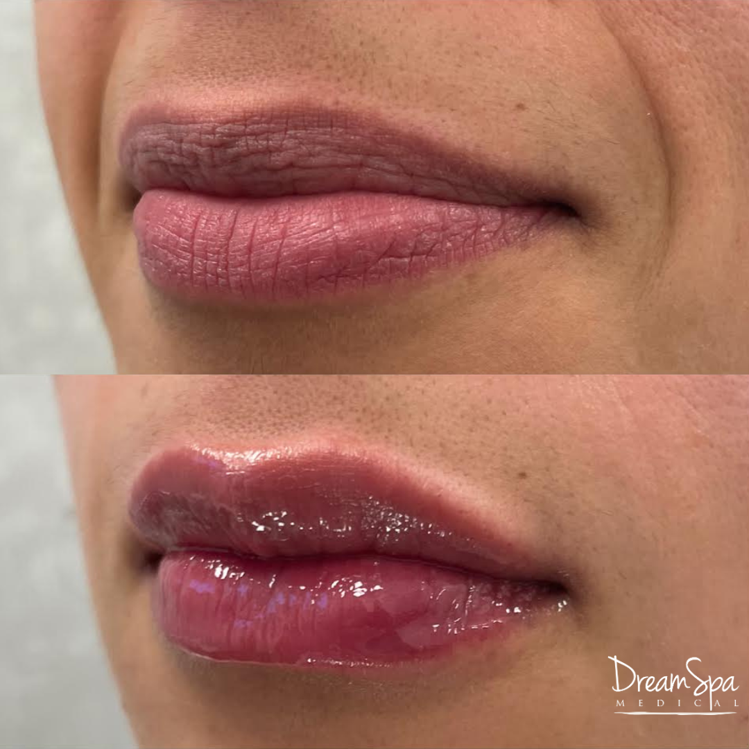 Lip Filler 1 - Dream Spa Medical