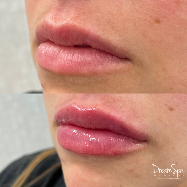 Lip Filler 4 - Dream Spa Medical