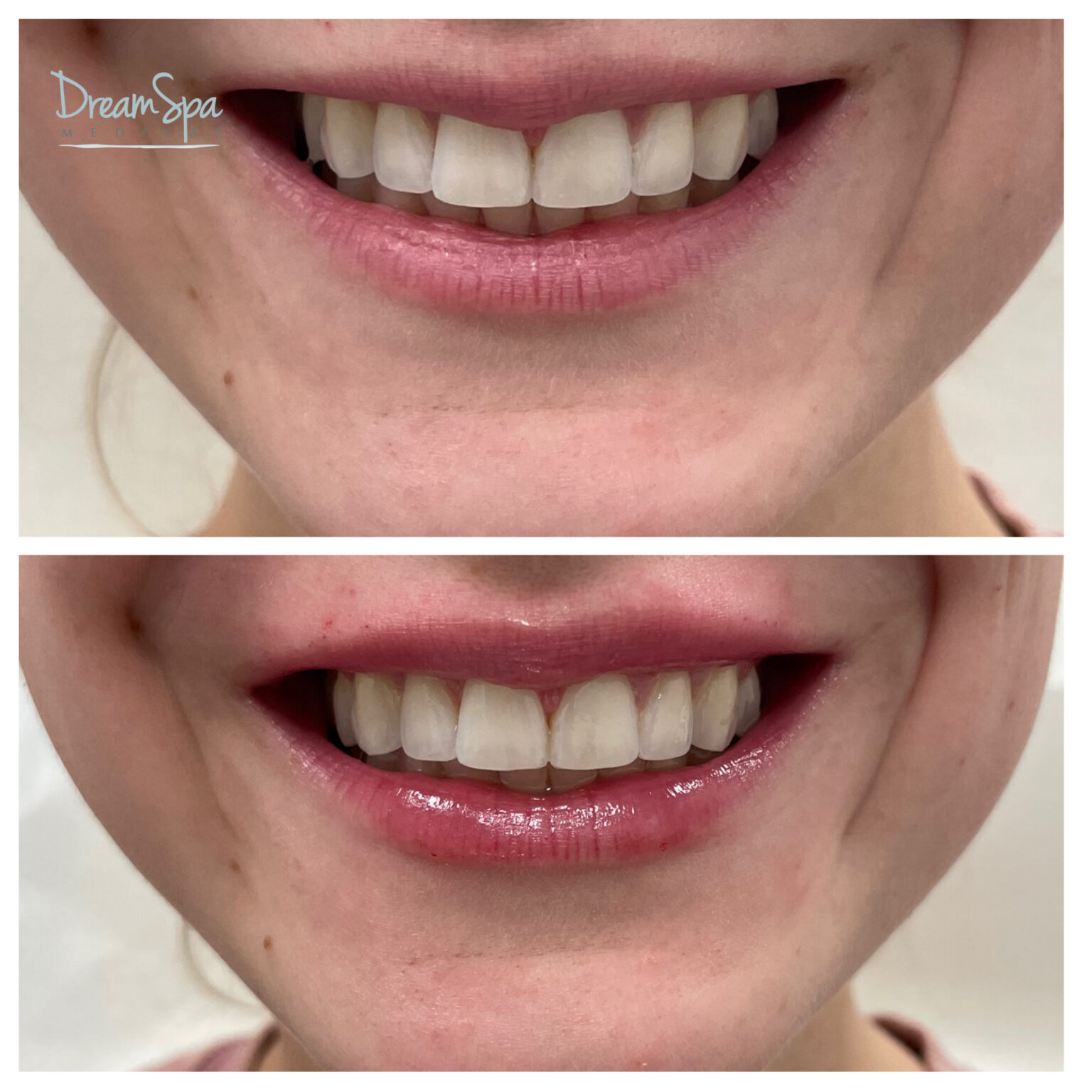 Lip Filler 9 - Dream Spa Medical