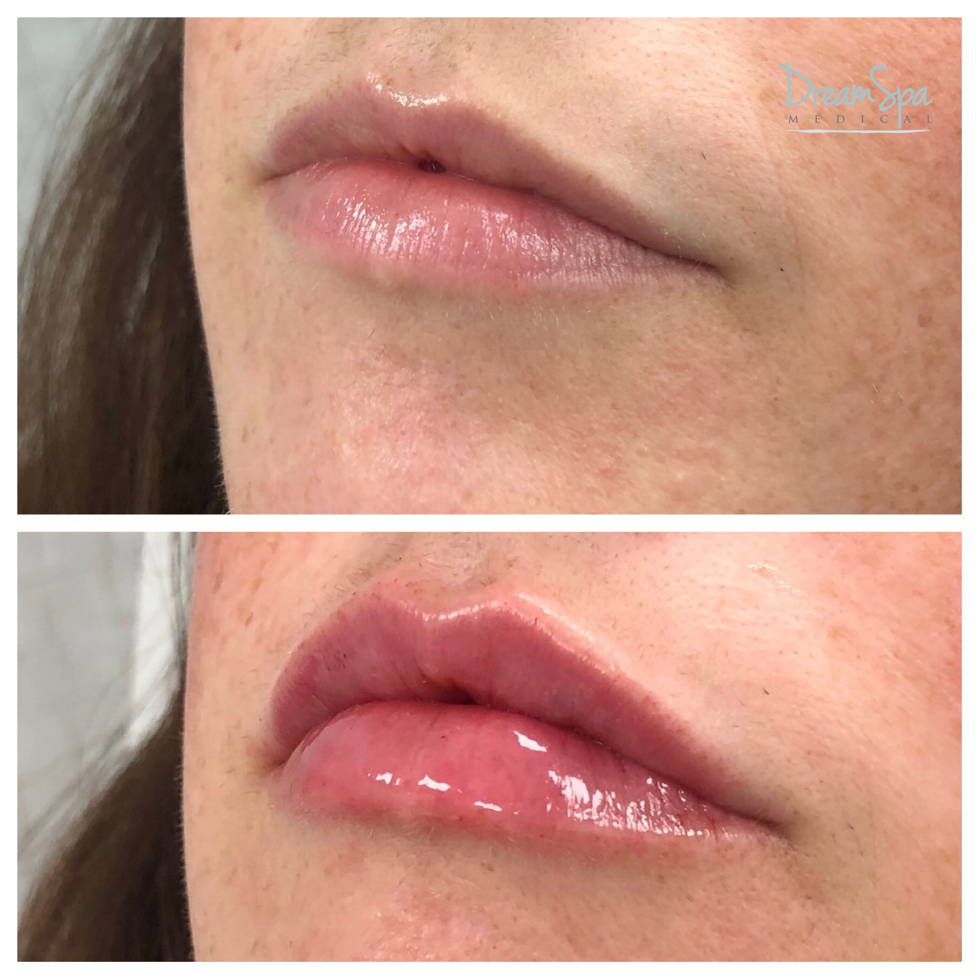 Lip Filler 11 - Dream Spa Medical