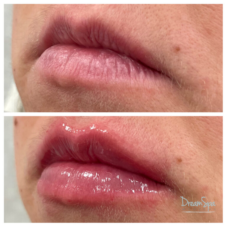 Lip Filler 12 - Dream Spa Medical