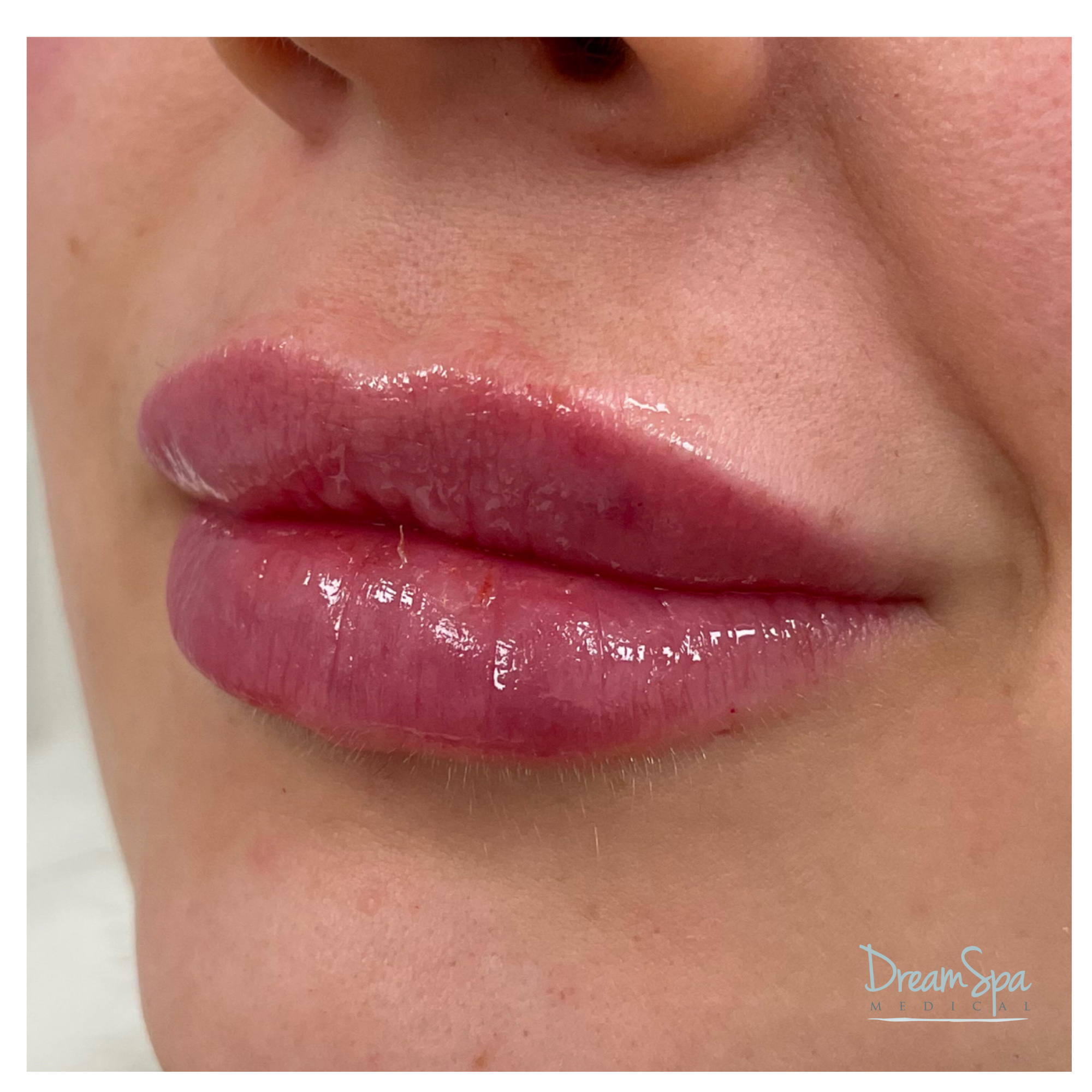 How to Get Fuller Natural Lips? - Dream Spa Medical - Blog