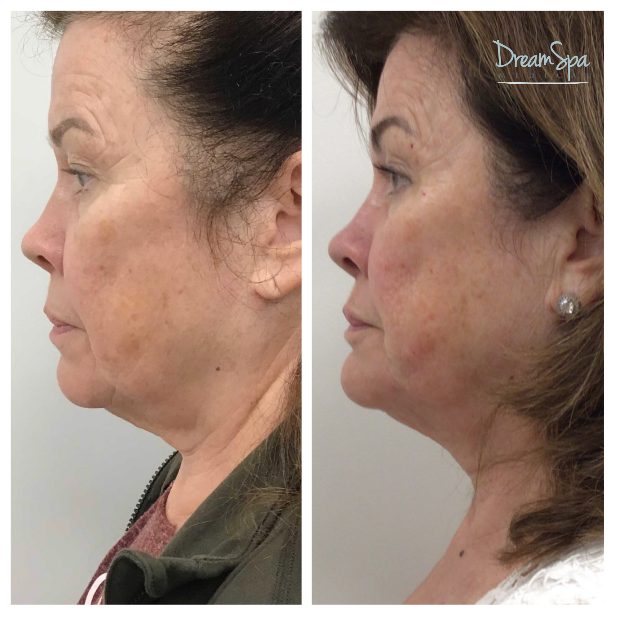 Profound 4 - Dream Spa Medical