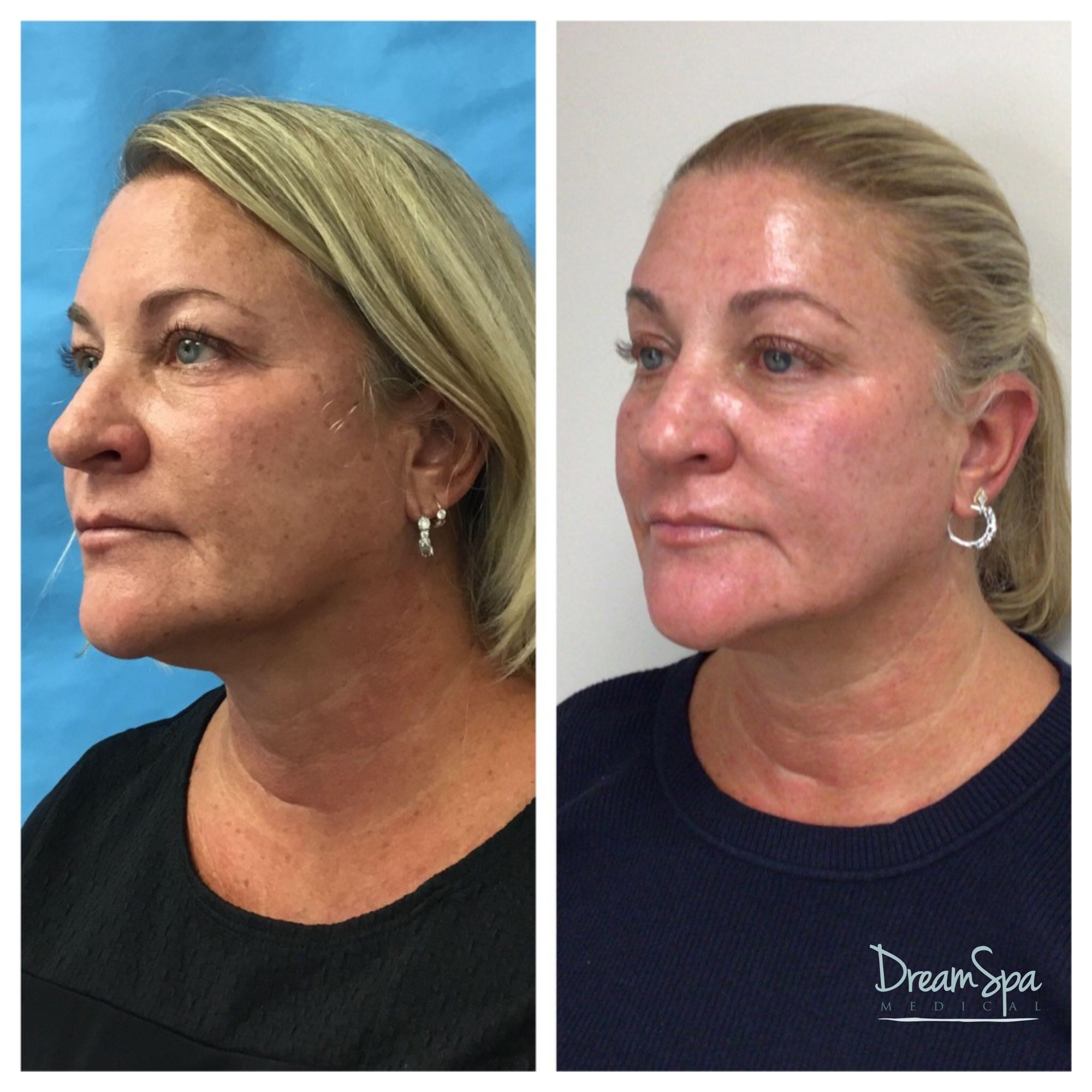 Profound 1 - Dream Spa Medical