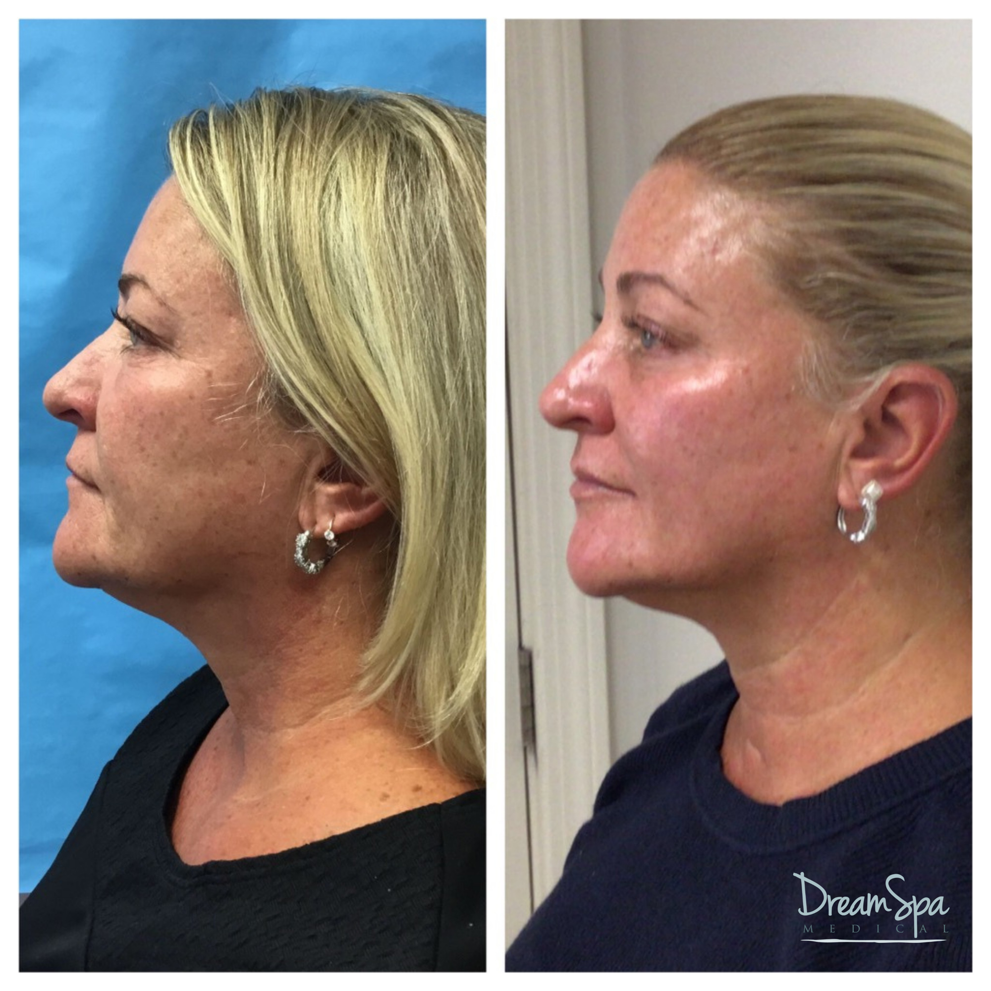 Profound 1 - Dream Spa Medical