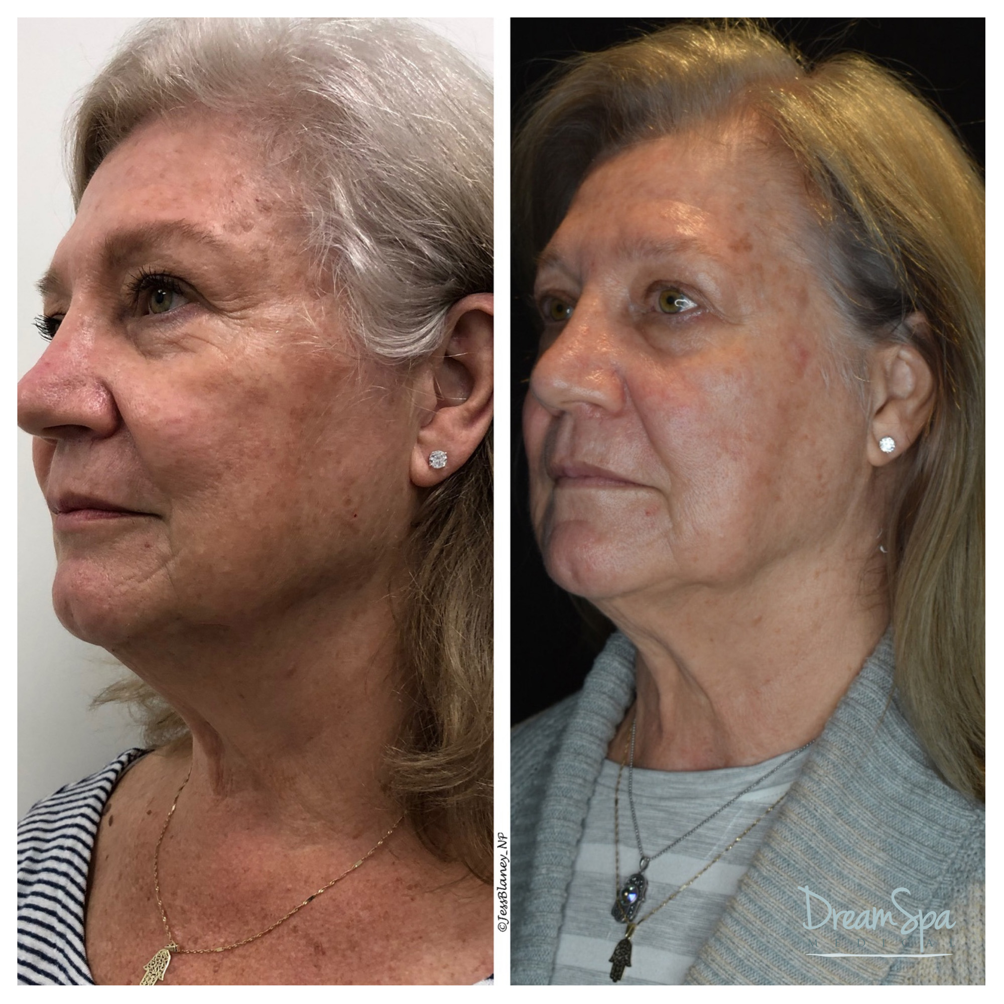 Profound 3 - Dream Spa Medical