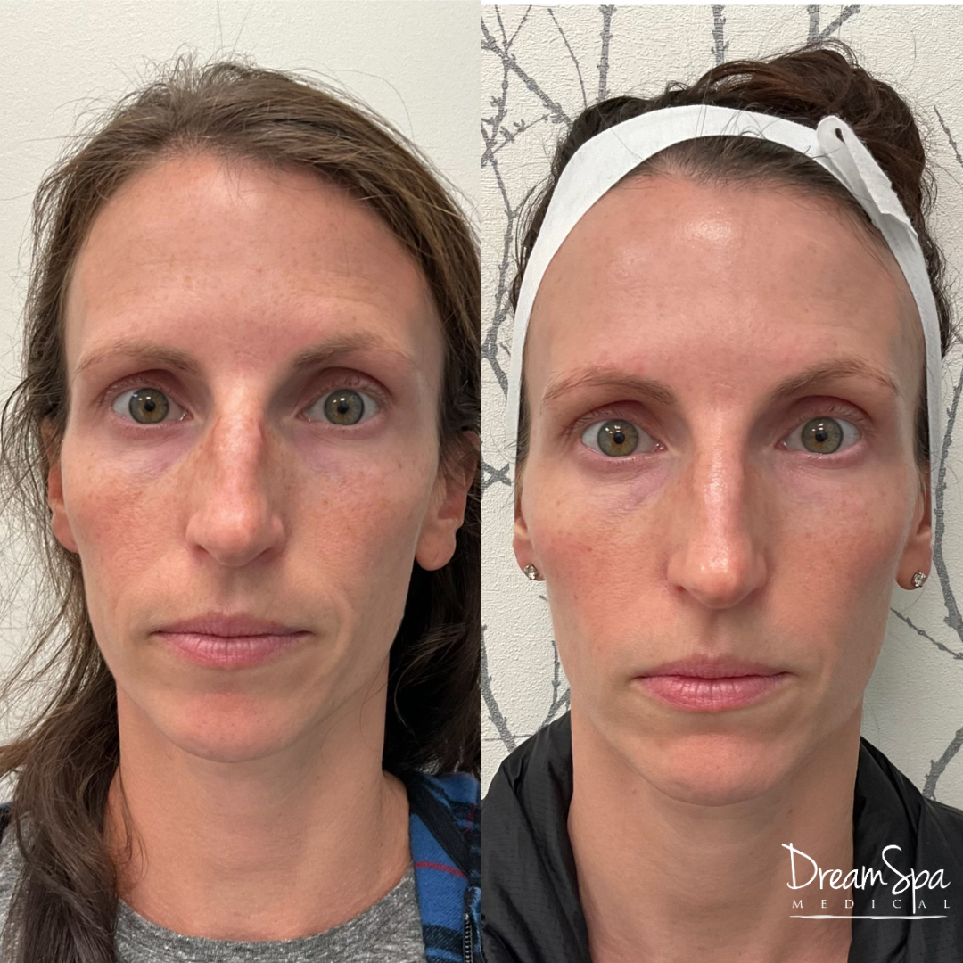 What is Sylfirm X? - Dream Spa Medical - Blog